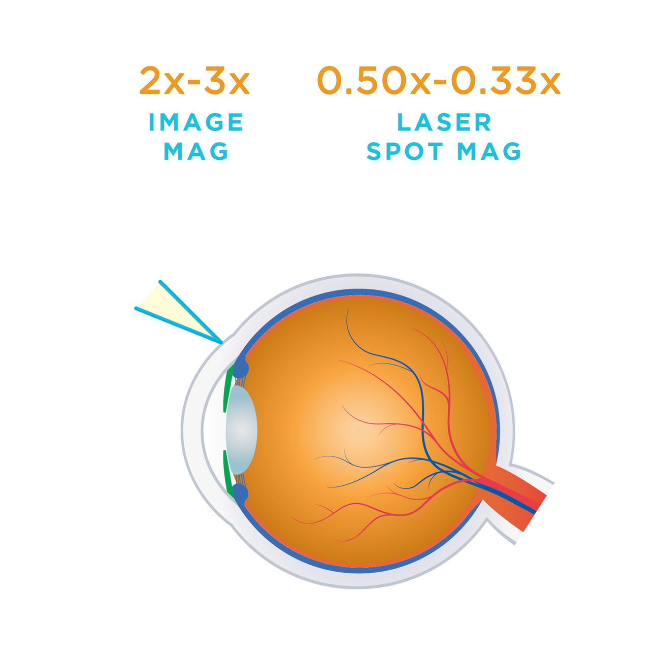 Volk Blumenthal Suturelysis Lens