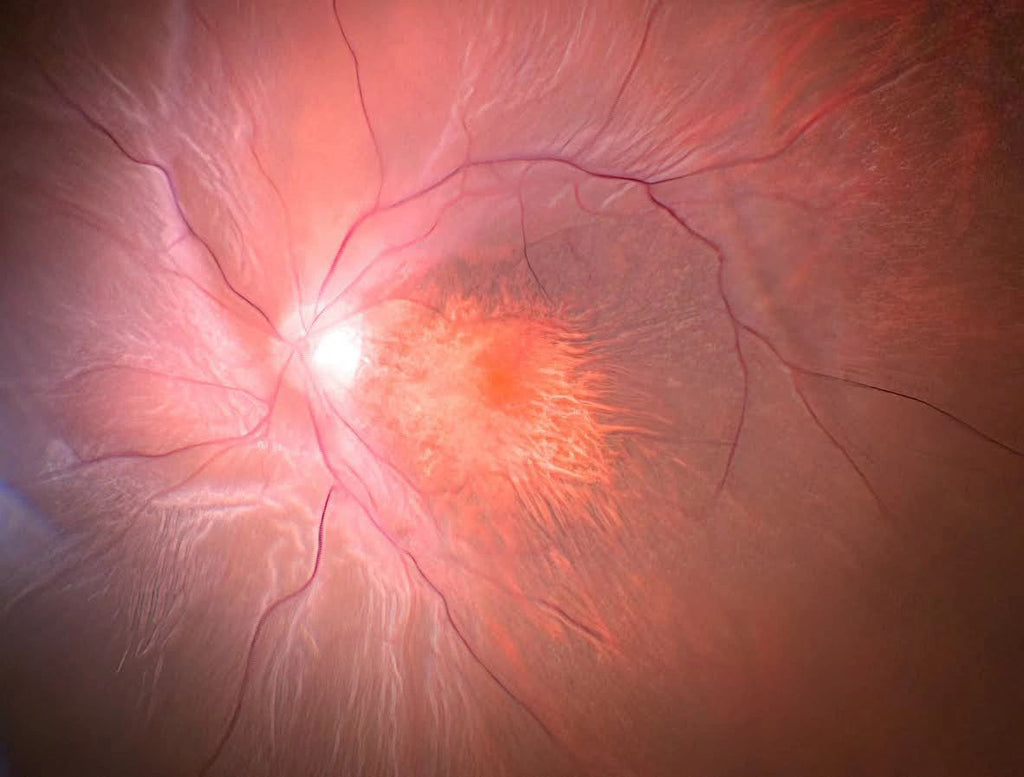 Volk®1 Single-Use Indirect WideField Vitrectomy Lens with SSV (1 box o ...