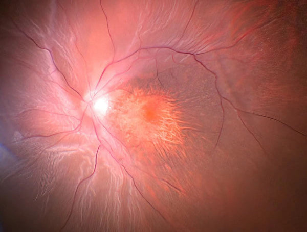 Volk®1 Single-Use Indirect WideField Vitrectomy Lens with SSV (1 box o ...