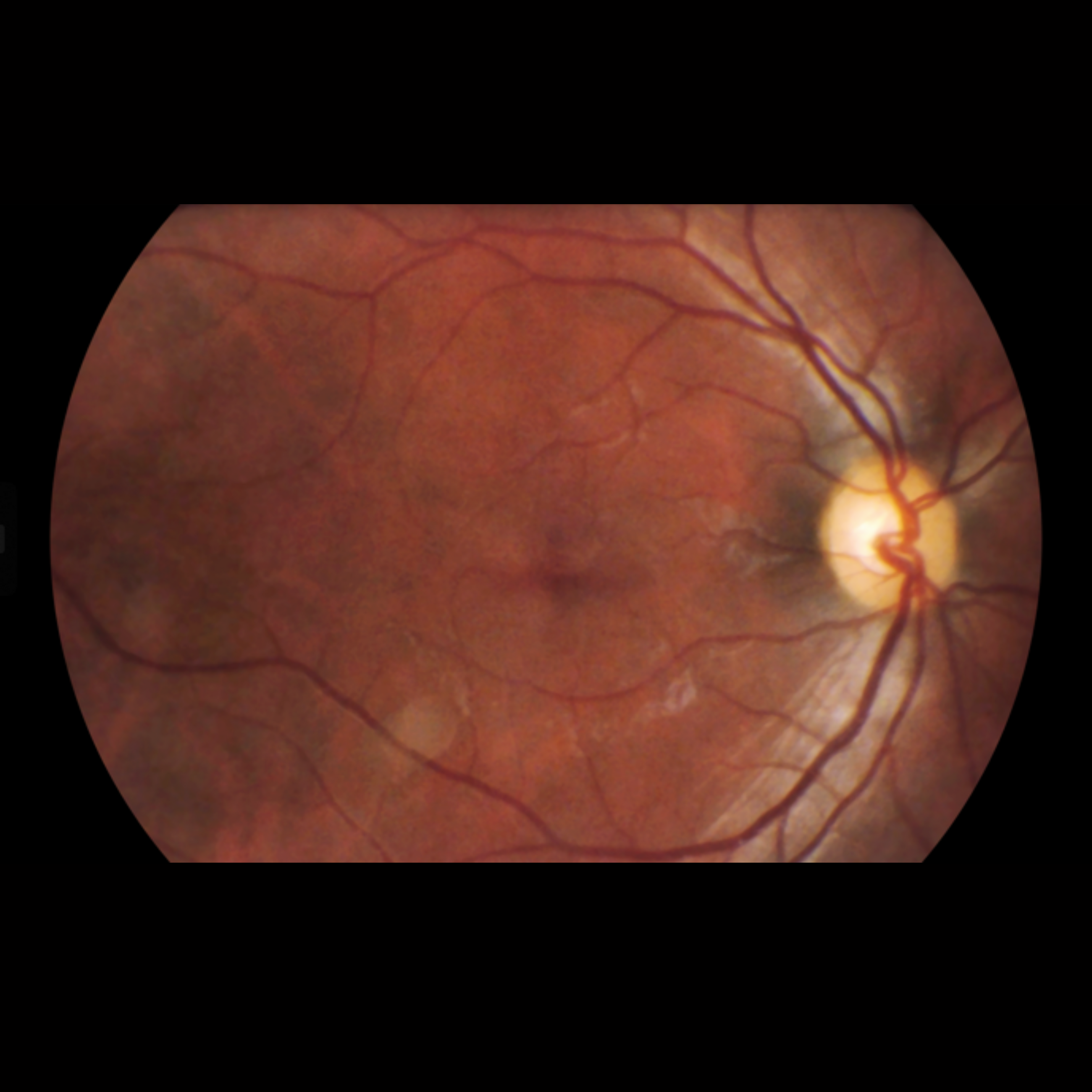 VIVA Portable Fundus Camera | Fast Retinal Imaging